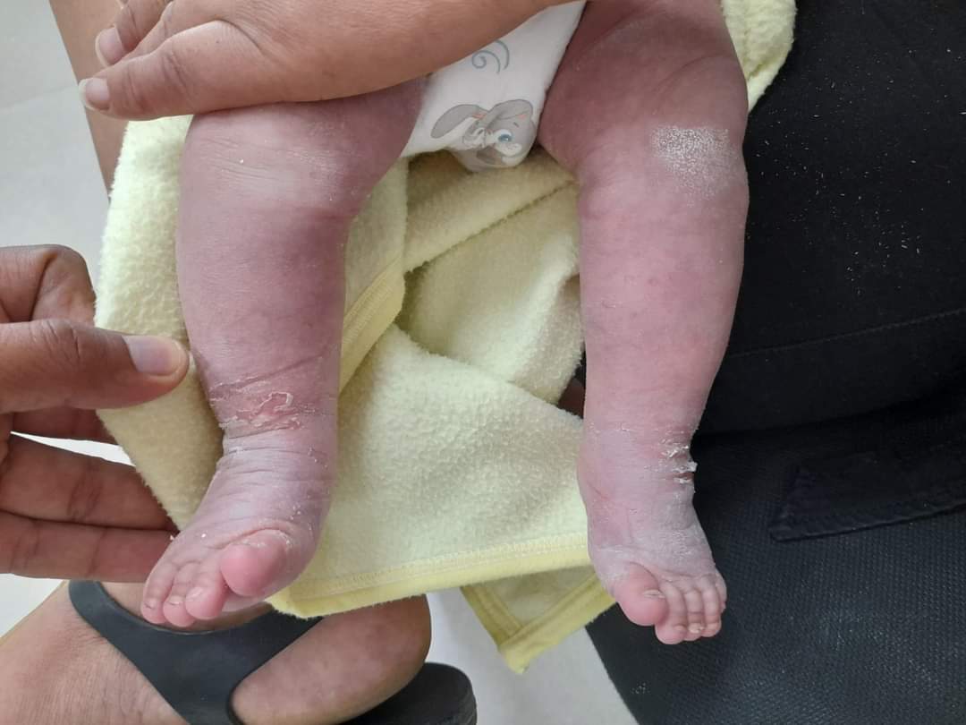 MANABÍ Al menos 140 niños superan el pie equinovaro con el método ...